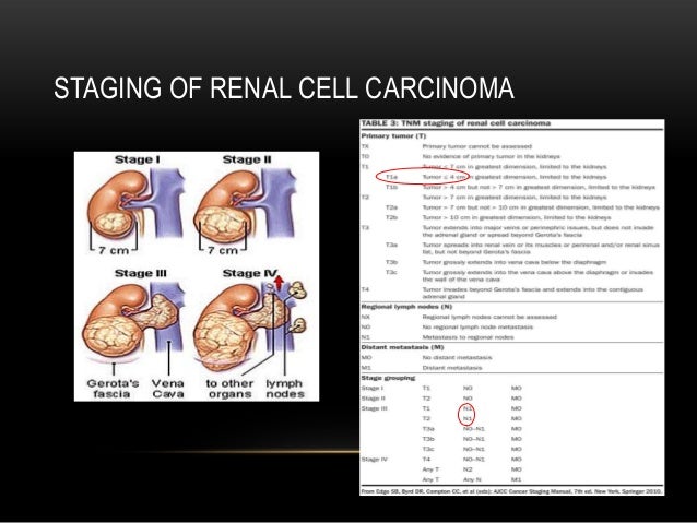 Management of renal cell carcinoma - presented at Asian Oncology Summ…