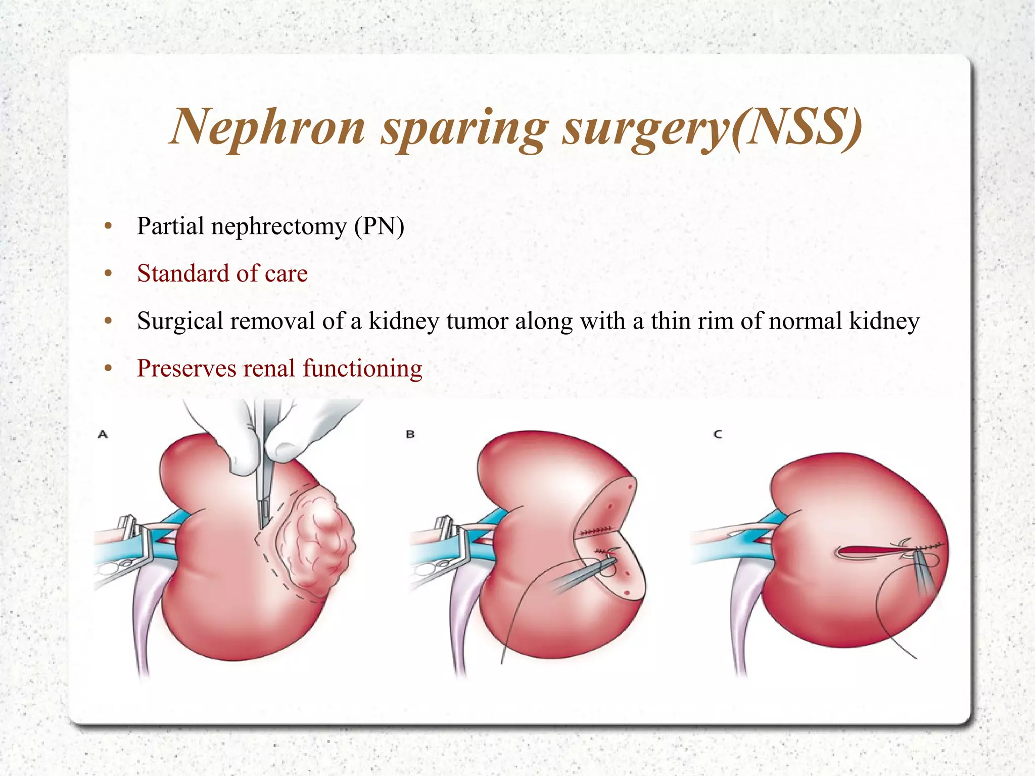Management of renal cell carcinoma and wilms' tumor | ODP