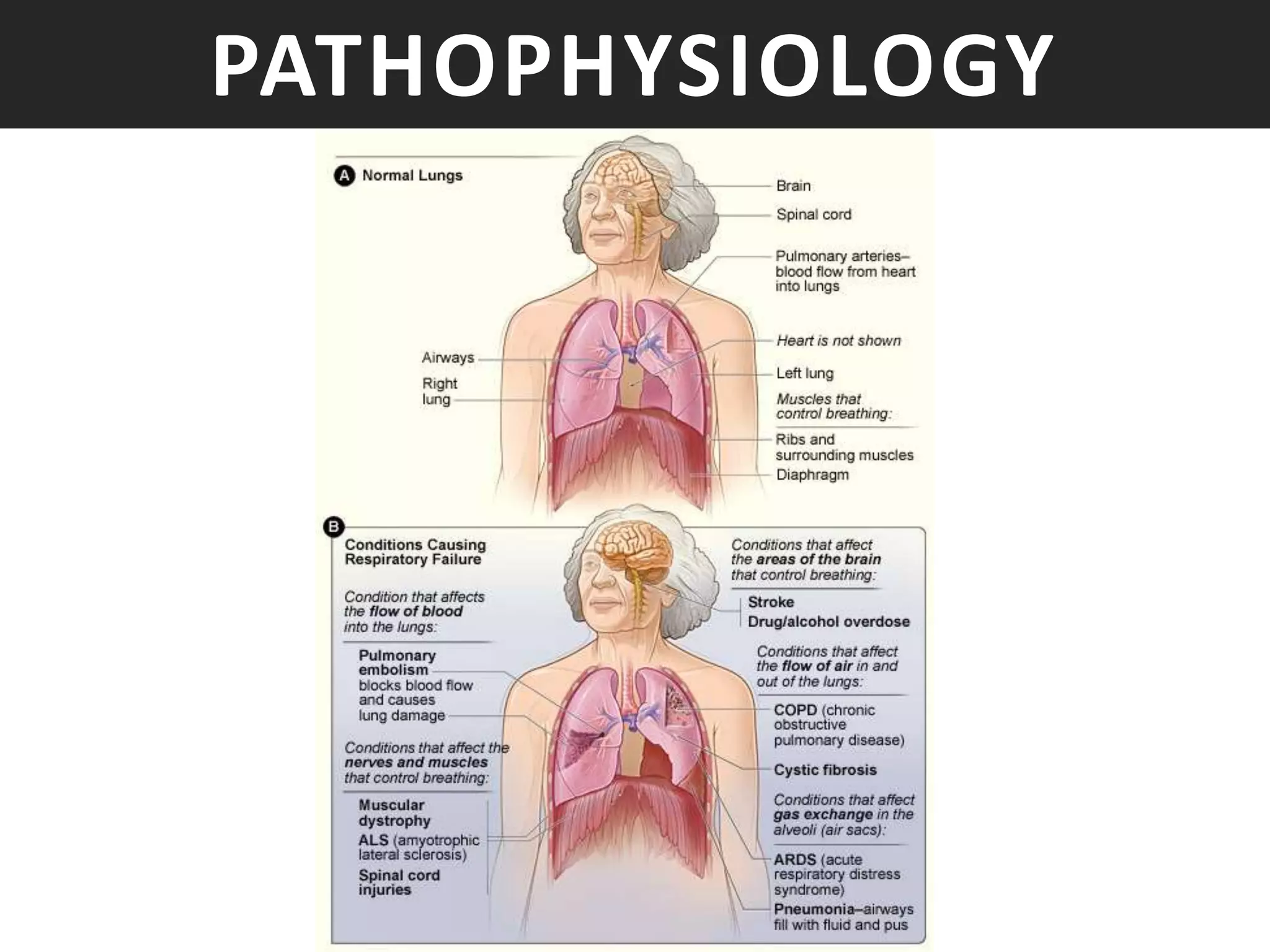Management of Respiratory Failure | PPTX | Lung and Respiratory Health ...
