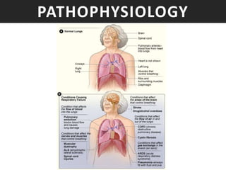 Management of Respiratory Failure | PPTX
