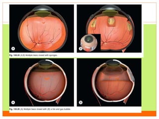 Management of retinal detachment.... | PPTX
