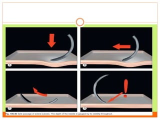 Management of retinal detachment.... | PPTX