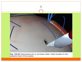 Management of retinal detachment.... | PPTX