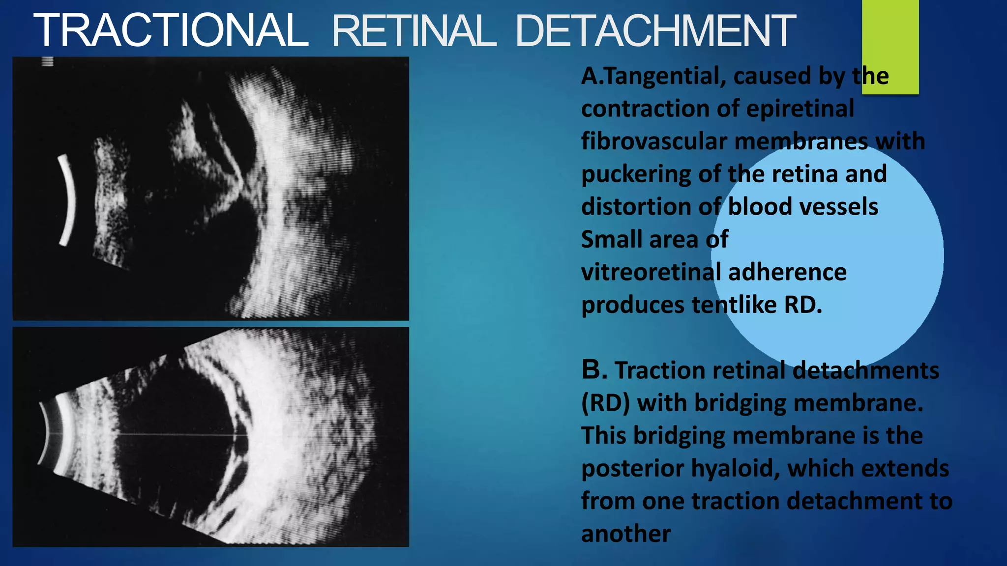 Management of retinal detachment | PPTX