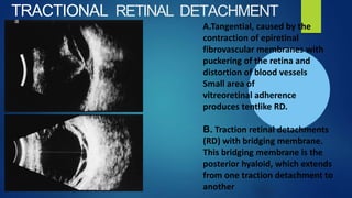 Management of retinal detachment | PPT