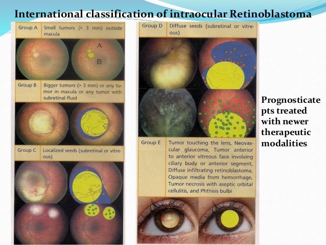 MANAGEMENT OF RETINOBLASTOMA & CURRENT TRENDS