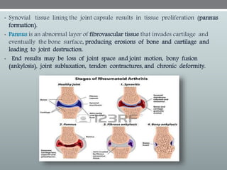 Management of Rheumatoid Arthritis | PPTX