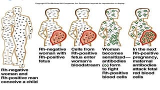 MANAGEMENT OF RH NEGATIVE pregnancy by dr mudasir | PPTX