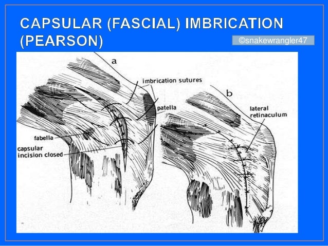 Management of ruptured cruciate ligament in dogs