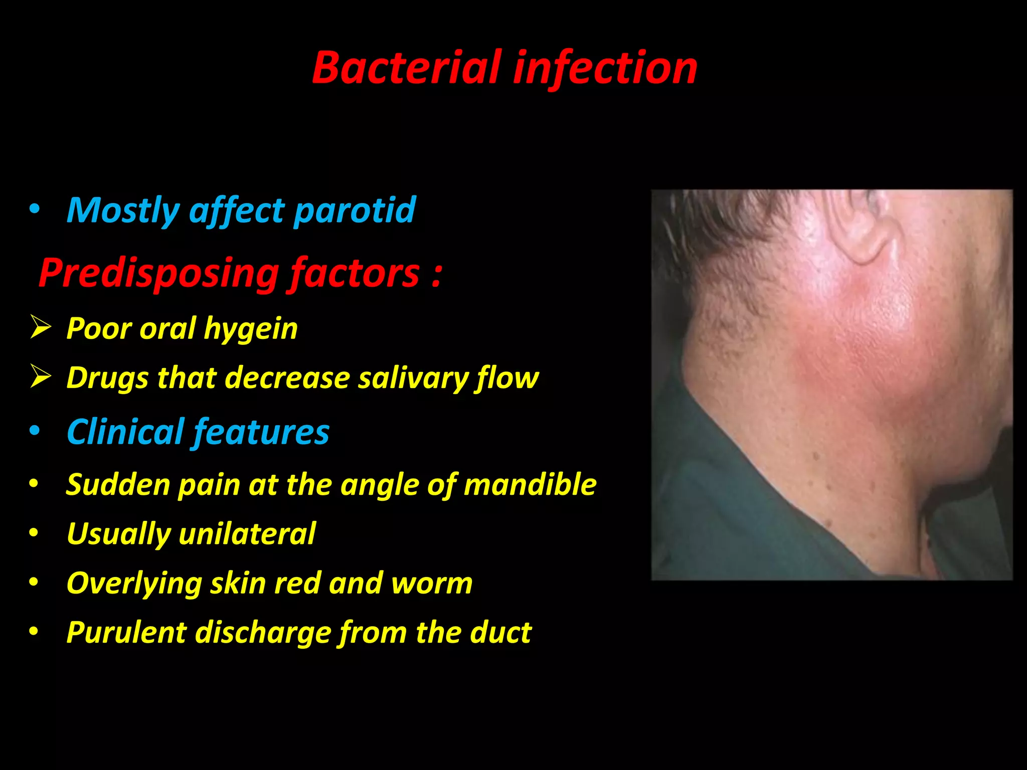 Management of salivary gland diseases | PDF