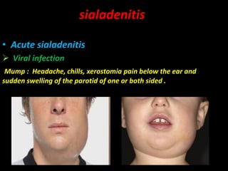 Parotid Sialadenitis