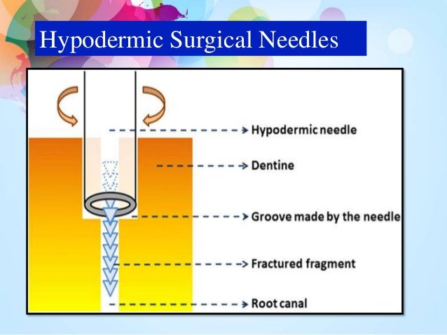 Management of seperated instruments- Dr.Jagadeesh kodityala