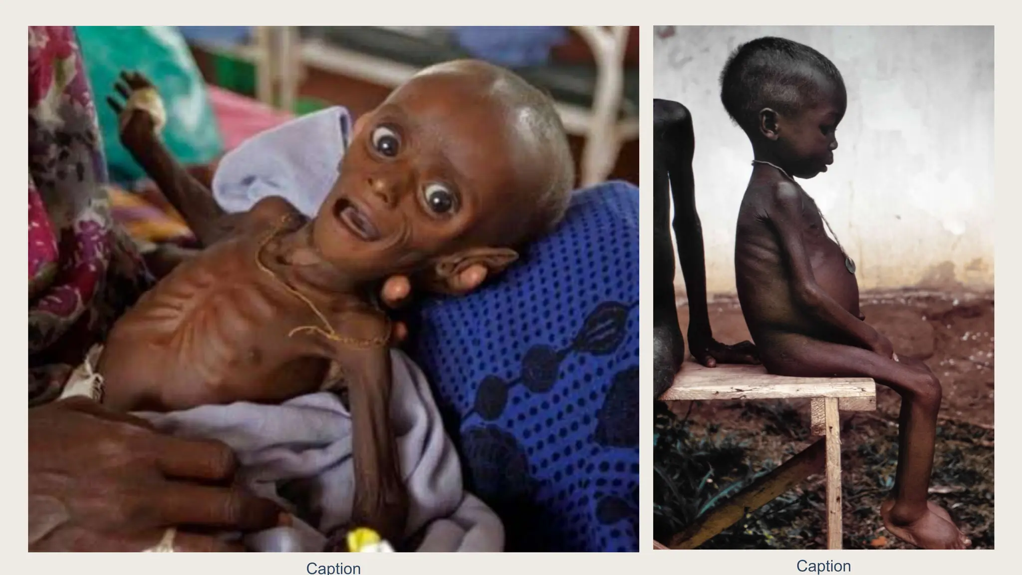 Management of Severe Acute Malnutrition.pptx