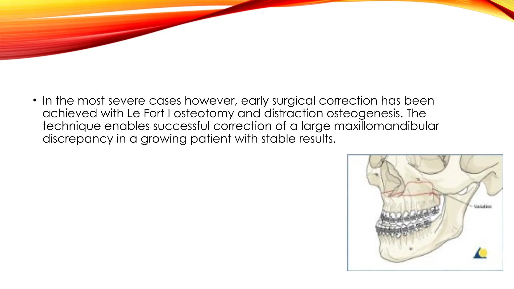 Management of severe maxillary hypoplasia with distraction osteogenesis ...