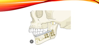 Management of severe maxillary hypoplasia with distraction osteogenesis | PPT