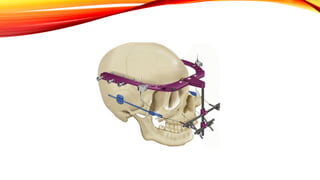 Management of severe maxillary hypoplasia with distraction osteogenesis | PPT