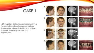 Management of severe maxillary hypoplasia with distraction osteogenesis | PPT