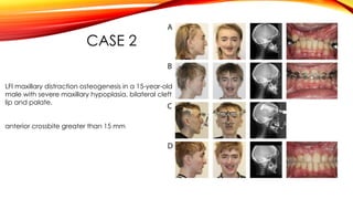 Management of severe maxillary hypoplasia with distraction osteogenesis | PPT