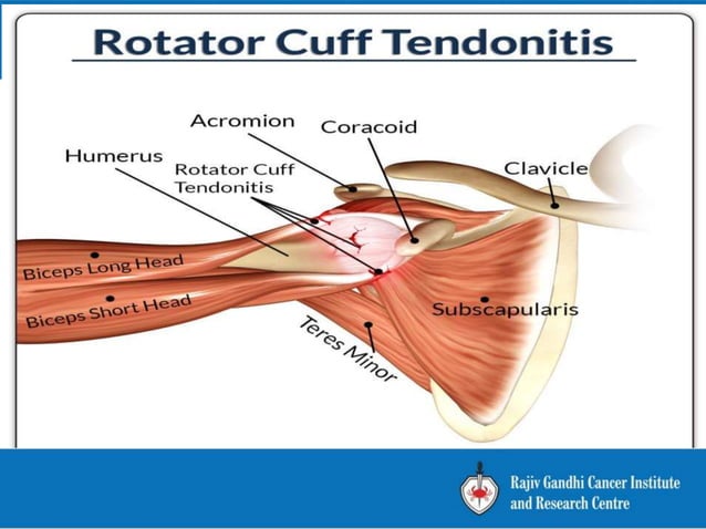 Management of shoulder dysfunction in breast cancer | PPT