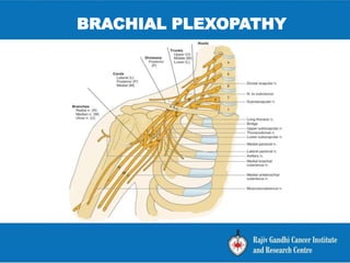 Management of shoulder dysfunction in breast cancer | PPT