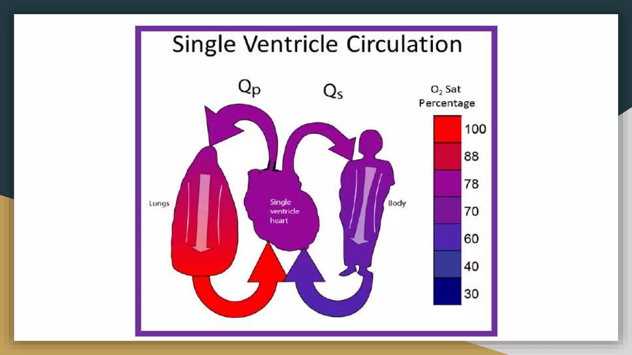 Management of Single Ventricle and evolution of Fontan surgery.pptx