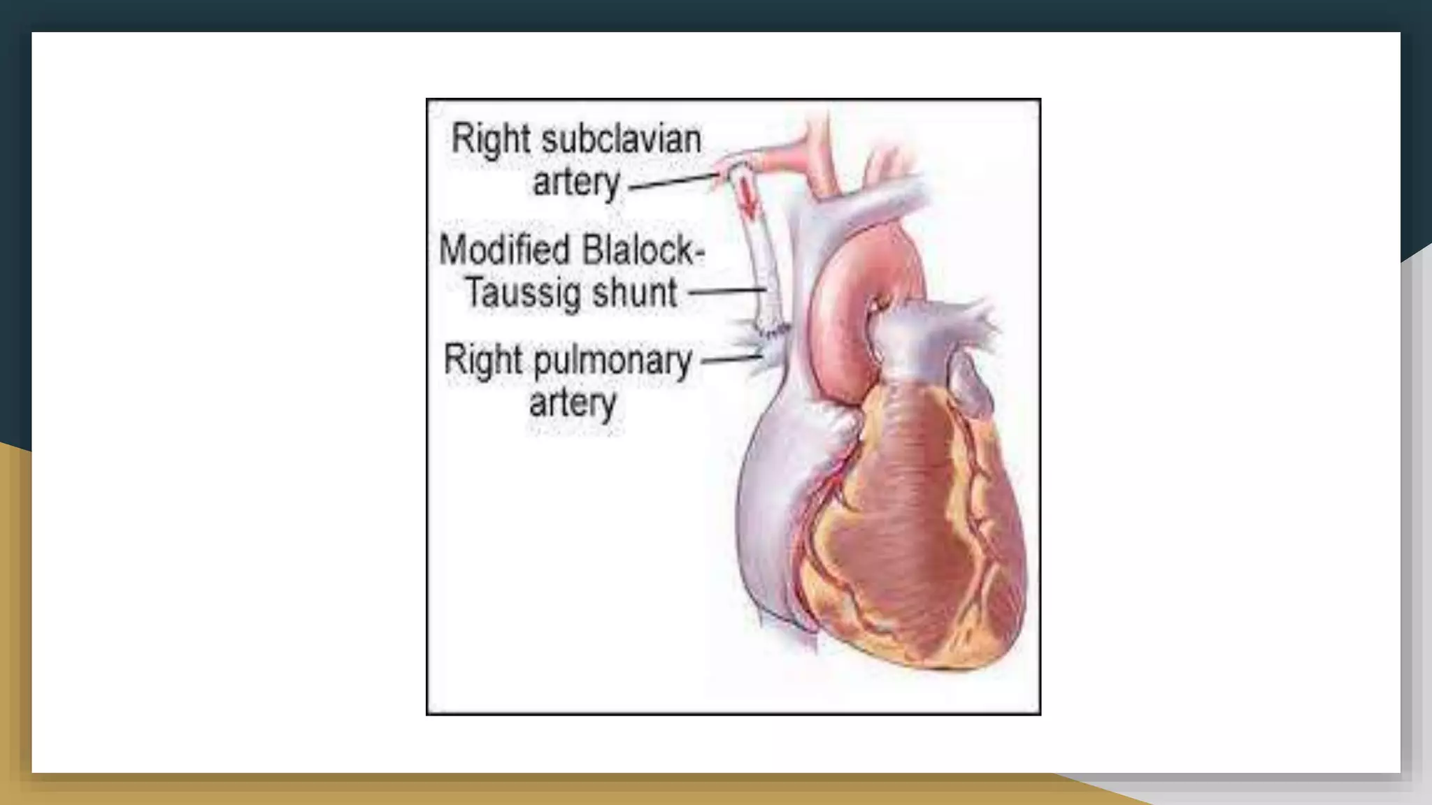 Management of Single Ventricle and evolution of Fontan surgery.pptx