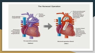 Management of Single Ventricle and evolution of Fontan surgery.pptx