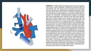 Management of Single Ventricle and evolution of Fontan surgery.pptx