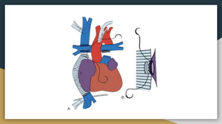 Management of Single Ventricle and evolution of Fontan surgery.pptx