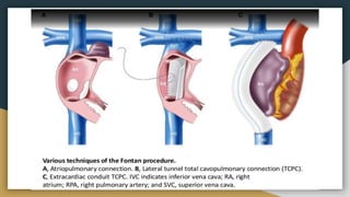 Management of Single Ventricle and evolution of Fontan surgery.pptx