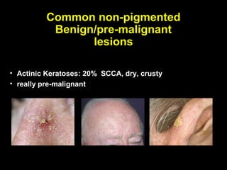 Management of skin cancers | PPT