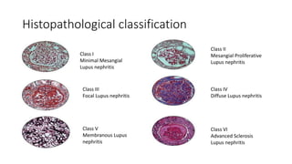 management of SLE.pptx