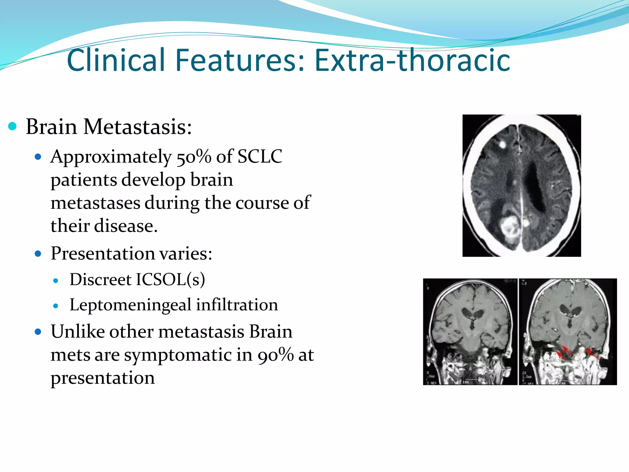 Management of small cell lung cancer | PPTX