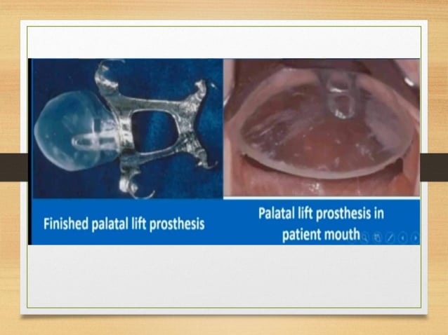 management of soft palate defect maxillofacial .pptx