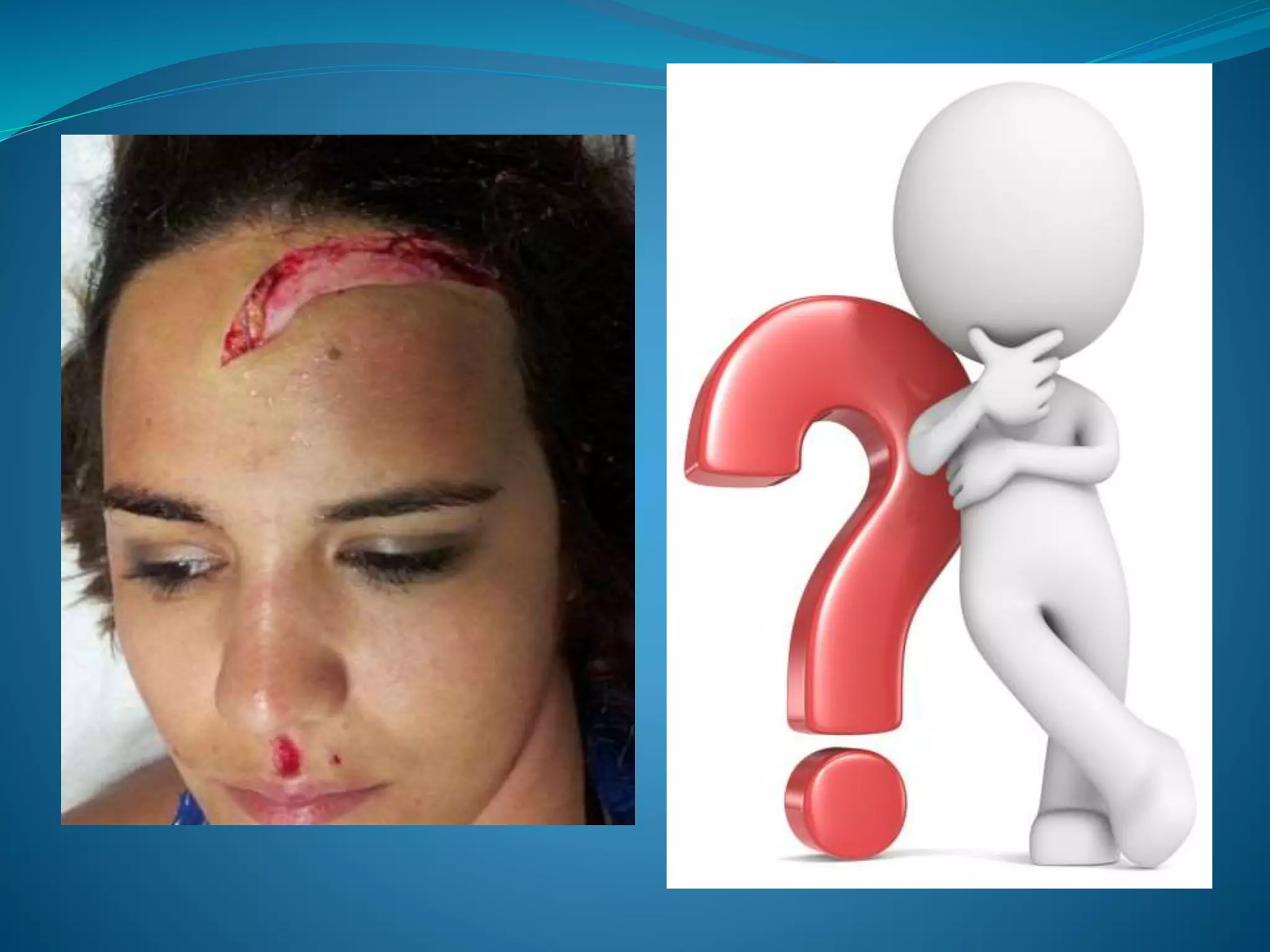 Management of soft tissue injuries in facial trauma | PPTX