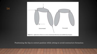 Management of spasticity | PPTX