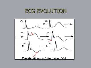 Management of stemi at emergency dept | PPT