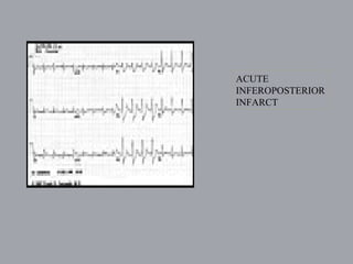 Management of stemi at emergency dept | PPT