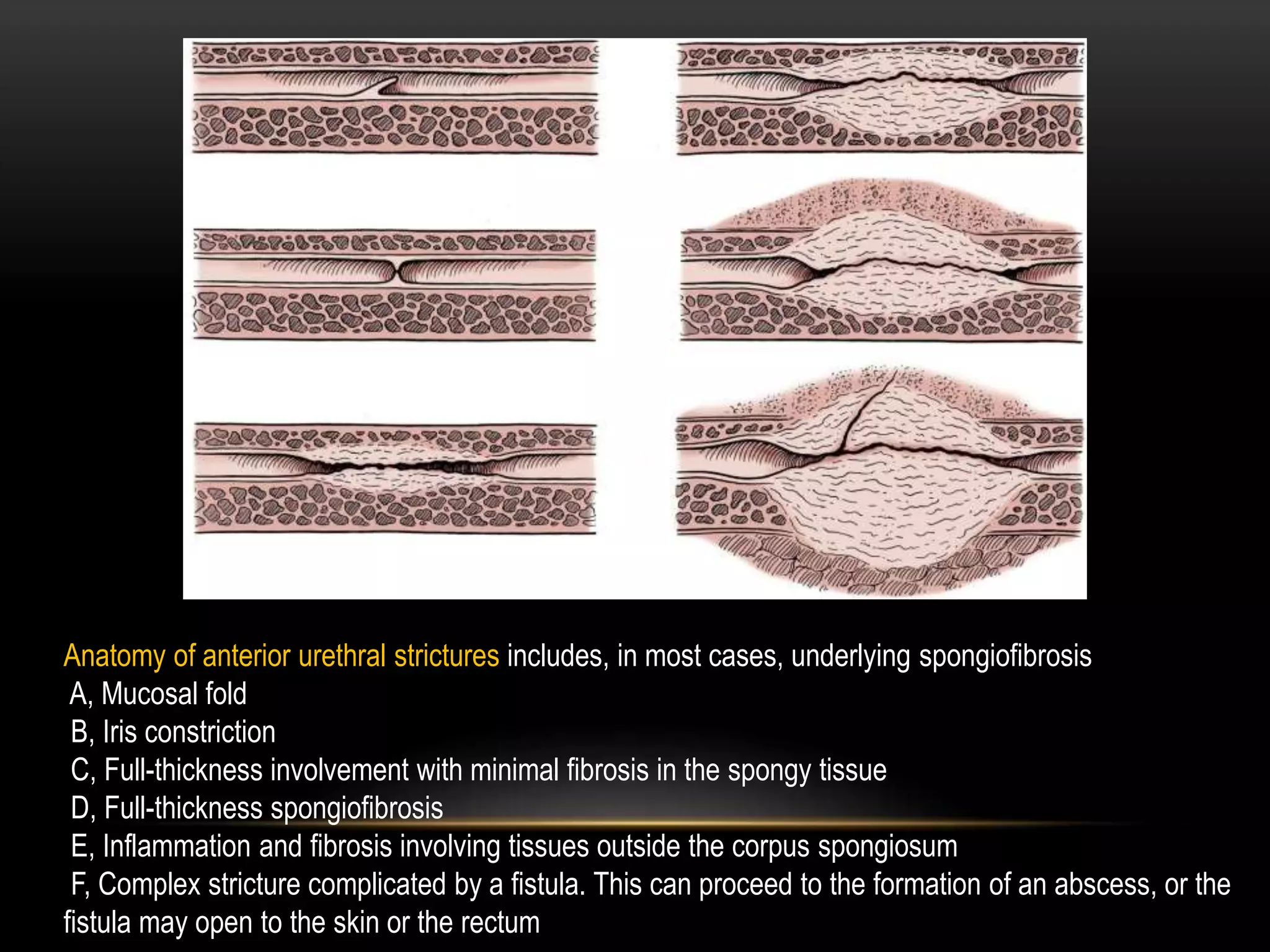Management of stricture urethra | PPTX