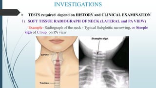 Management of stridor | PPTX