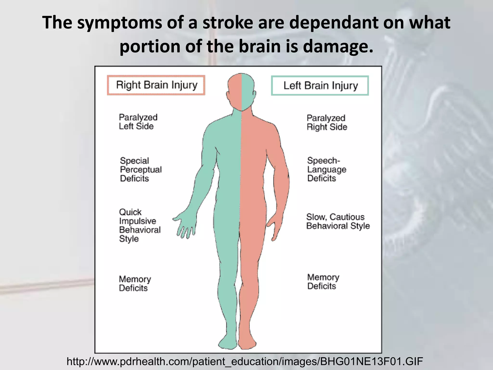 Management of stroke | PPTX