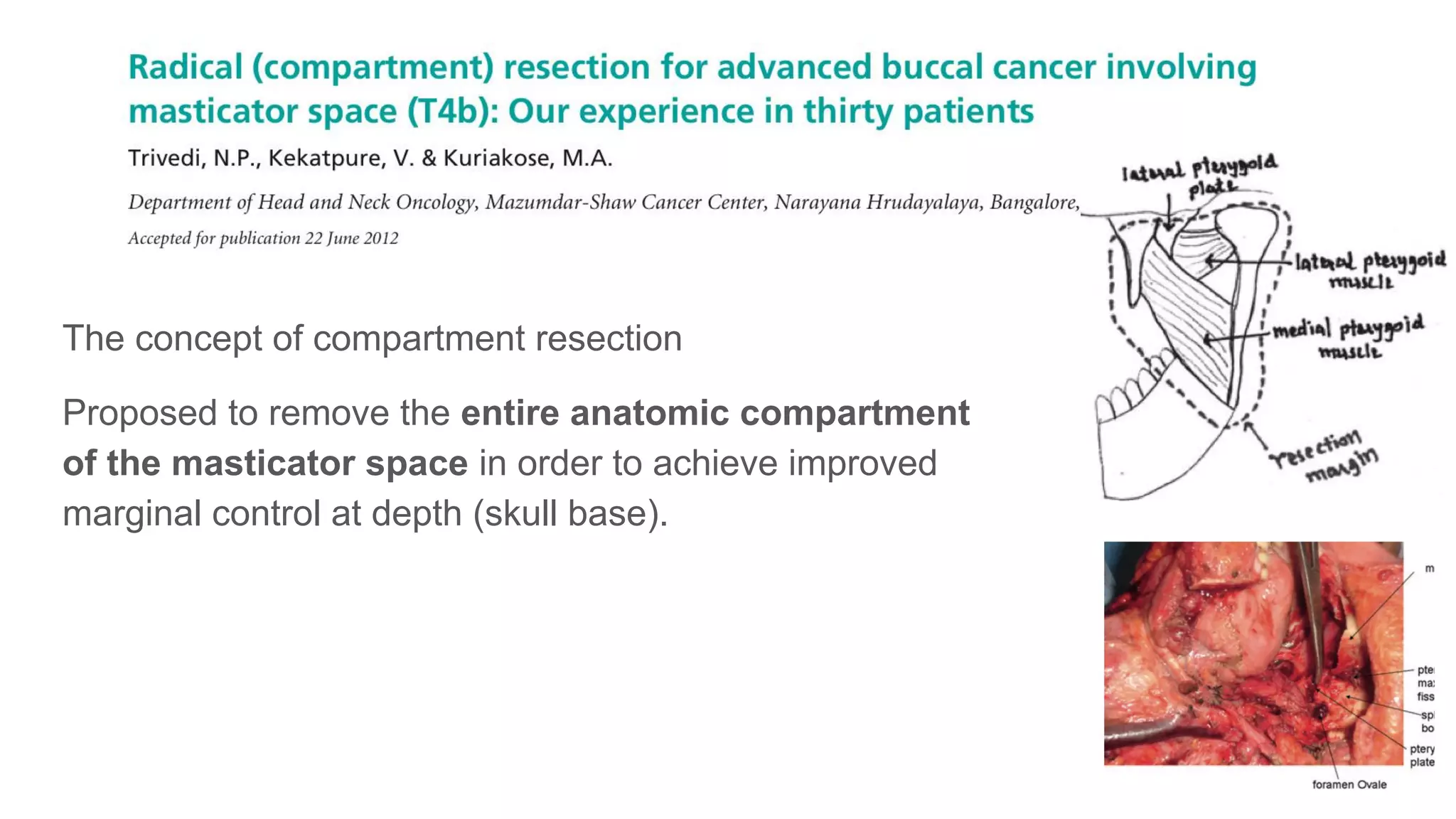 Management of supranotch disease by Dr Ankit Vishwani MCh head and neck ...