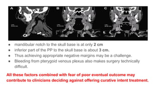 Management of supranotch disease by Dr Ankit Vishwani MCh head and neck ...