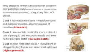 Management of supranotch disease by Dr Ankit Vishwani MCh head and neck ...