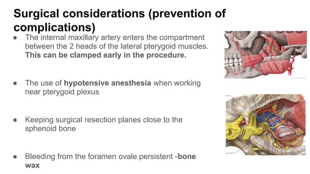 Management of supranotch disease by Dr Ankit Vishwani MCh head and neck ...
