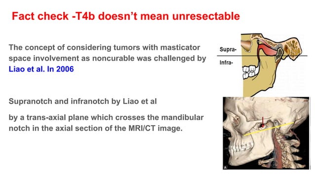 Management of supranotch disease by Dr Ankit Vishwani MCh head and neck ...