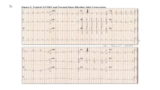 Management of svt in adult | PPTX
