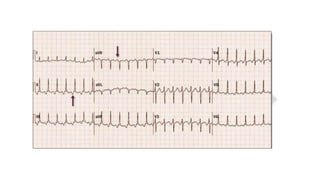 Management of svt in adult | PPTX
