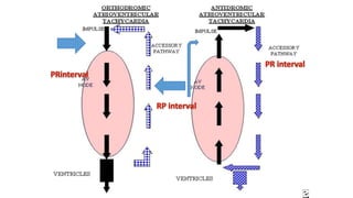Management of svt in adult | PPTX