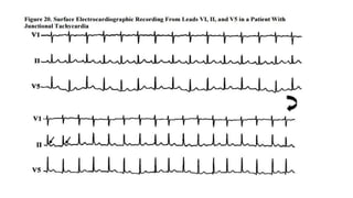 Management of svt in adult | PPTX